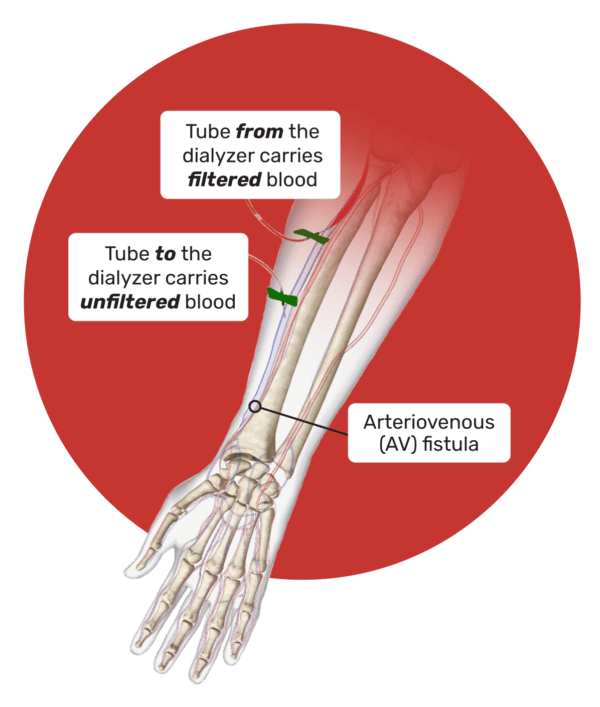 Flex Vessel Prep - Venture Med Group